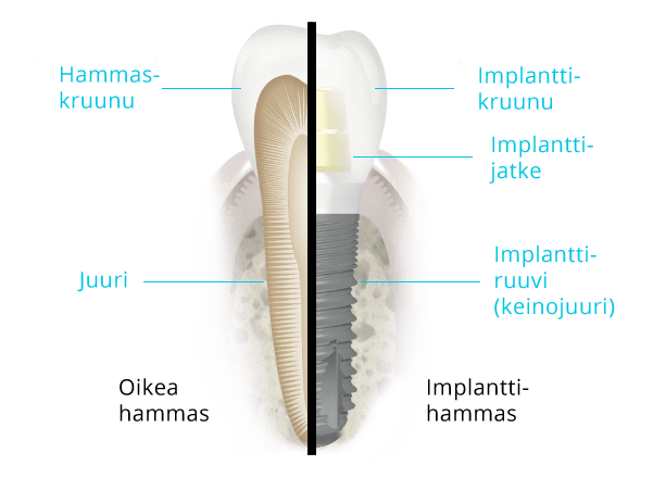 10 hyvää syytä hankkia hammasimplantti • Implanttimatkat.fi
